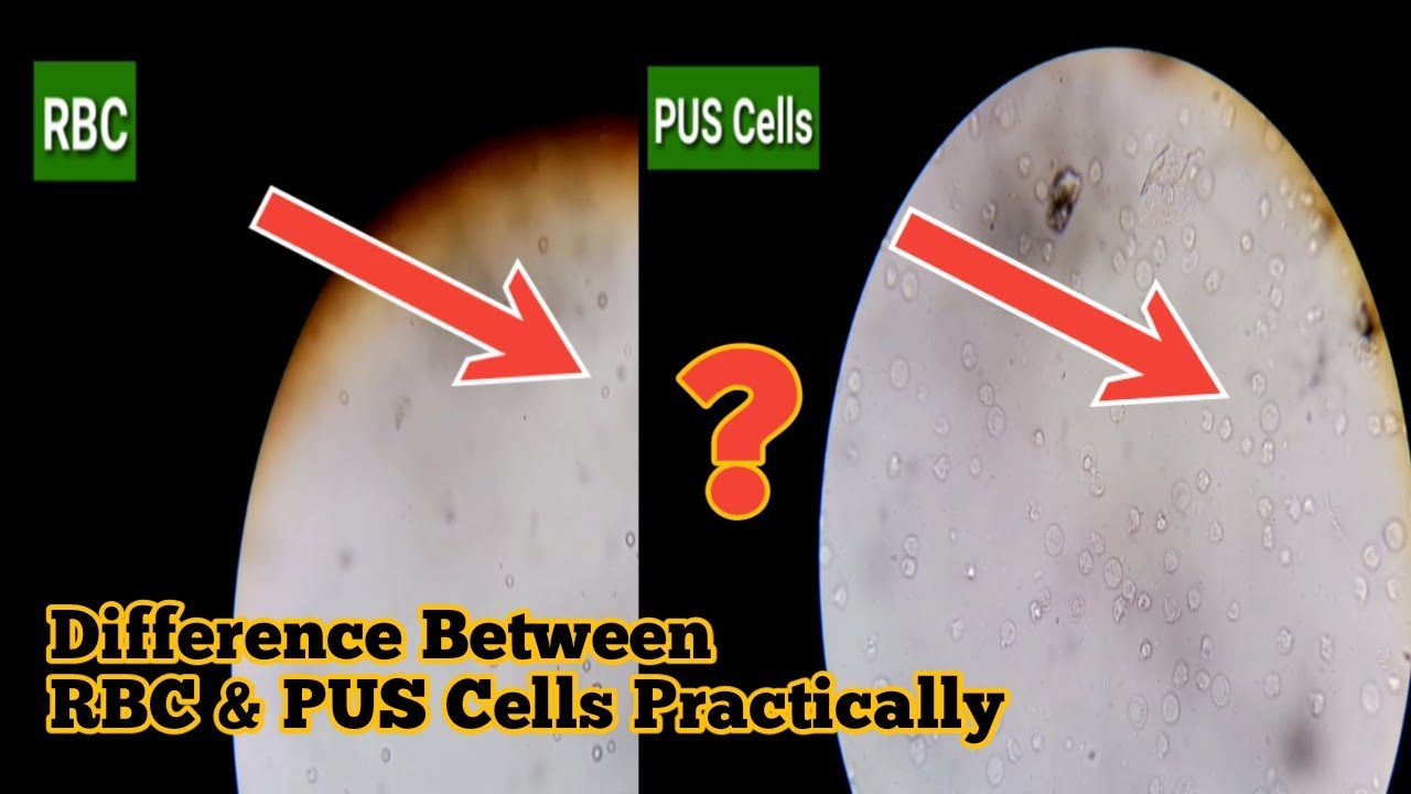Difference Between RBC & PUS Cells Practically Under the Microscope ...