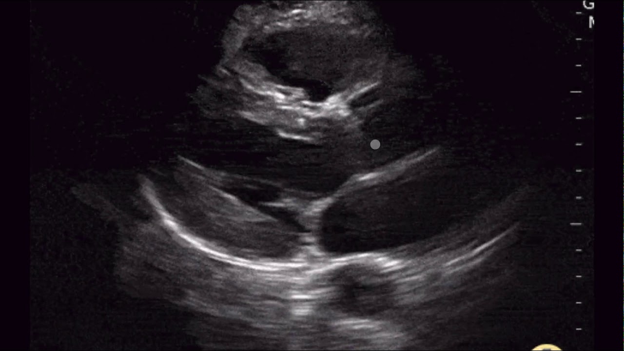 Normal Parasternal Long Axis View - YouTube