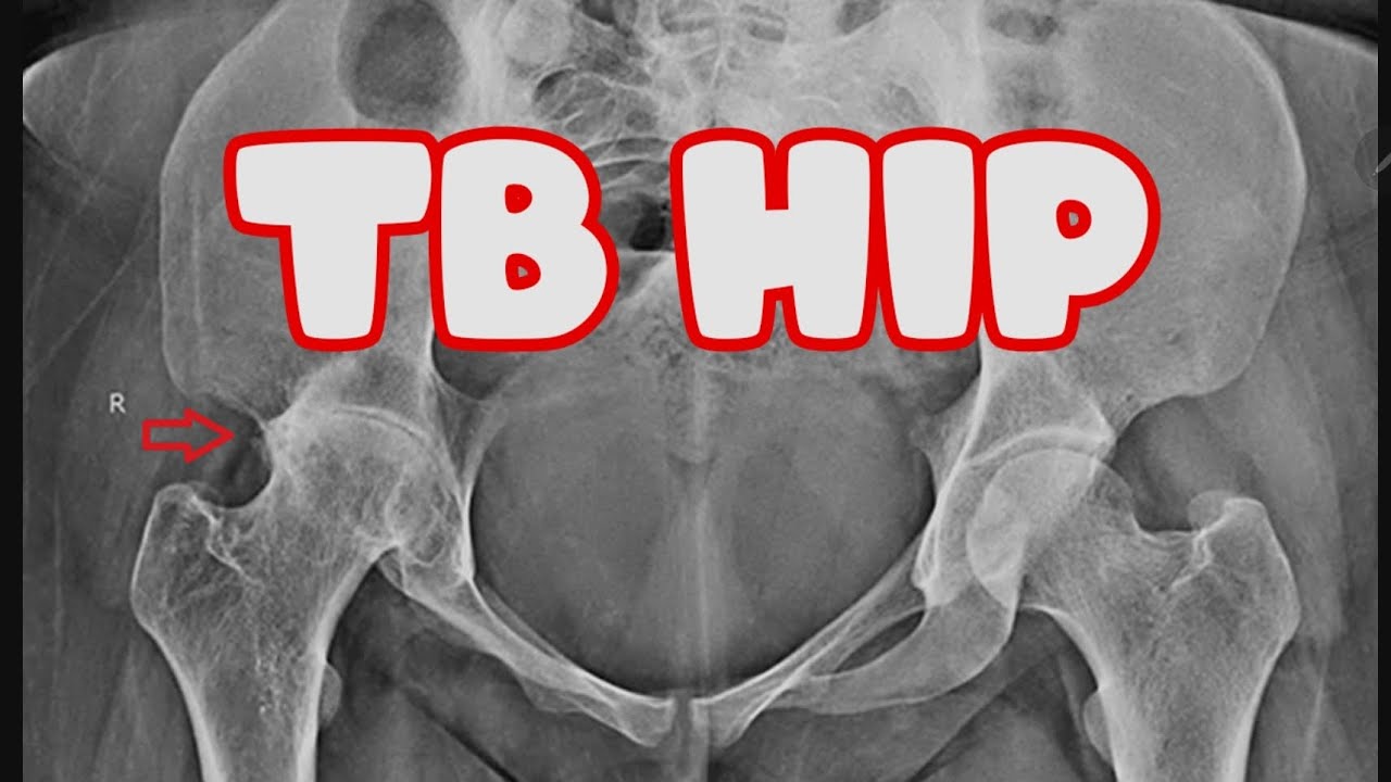TB HIP | ETIOPATHOGENESIS | CLINICAL FEATURES | STAGING | MANAGEMENT ...