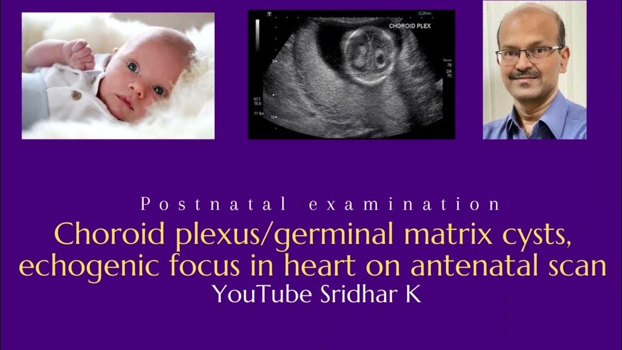 Choroid Plexus And Germinal Matrix Cyst Echogenic Focus In Fetal Heart