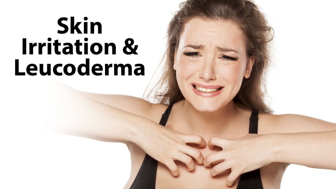Skin Irritation/Itching In Leucoderma Patient - What To Do? - YouTube