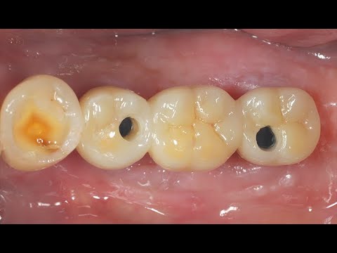 Posterior restoration using bite impression procedure - YouTube