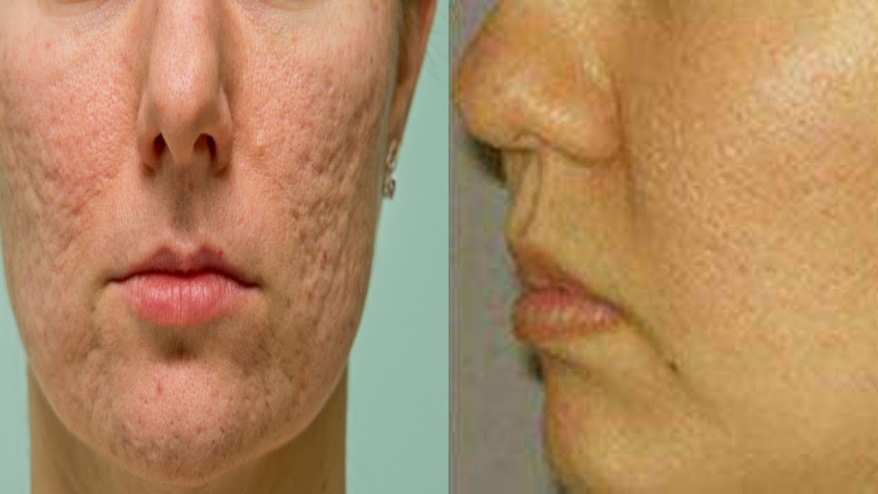 Face Ke Gadde Kaise Bhare / How To Remove Holes From Face In Hindi ...