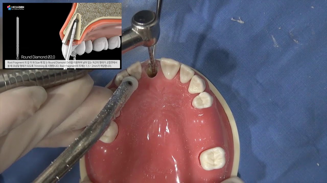 Root Membrane technique Hands-on - YouTube
