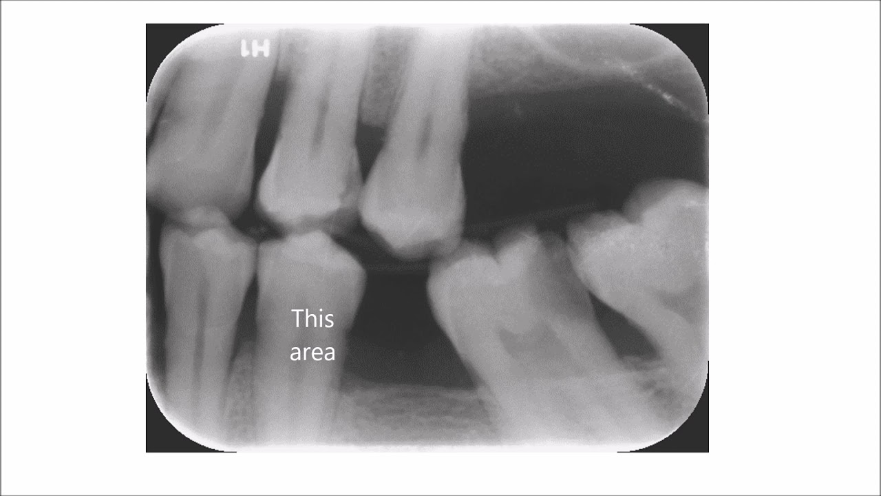 Cementum (Root Caries) 2 - YouTube
