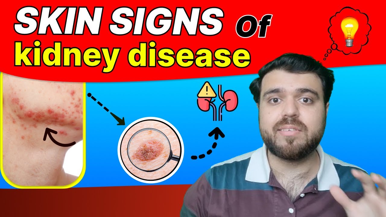Skin signs of Kidney Disease | Health File - YouTube
