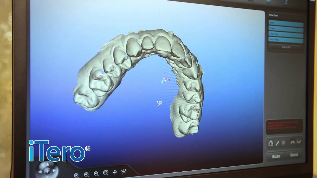 Hidden Valley Orthodontics: Our iTero Scanner - YouTube