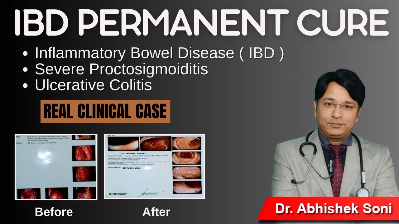 IBD Permanent Cure|Severe Proctosigmoiditis | Ulcerative Colitis ...