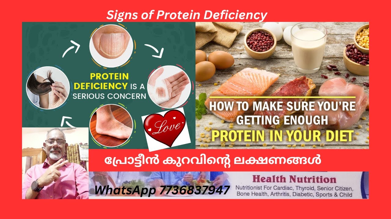 SIGNS AND SYMPTOMS OF PROTEIN DEFICIENCY / PART 2 - YouTube