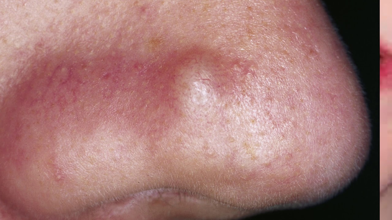 SKIN LESIONS (Graphic Photos) - YouTube