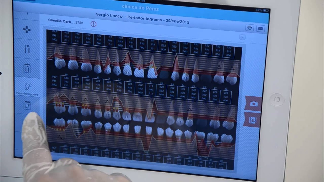 DENTSIO Periodontal Chart - YouTube