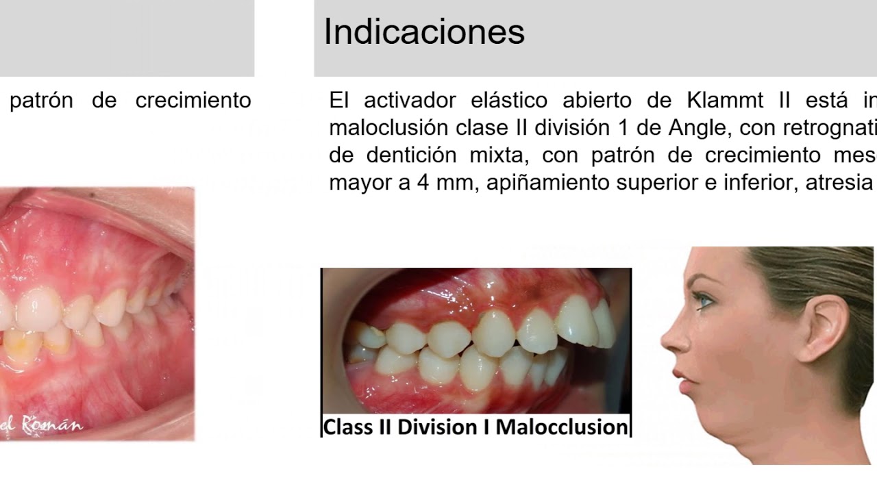 Activador Elástico de Klammt (clase II) - YouTube