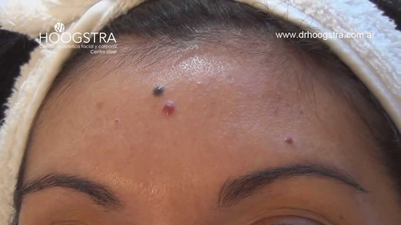 Lunares, tratamiento estético con láser Helios II - YouTube