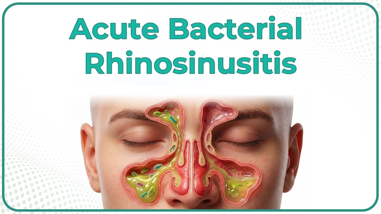 Acute Bacterial Rhinosinusitis 👃 (ABRS) : ENT Lectures - YouTube