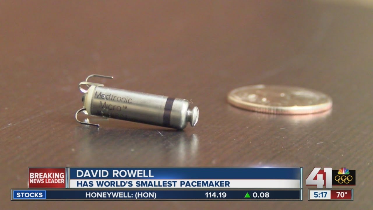 Northland man has world’s smallest pacemaker - YouTube