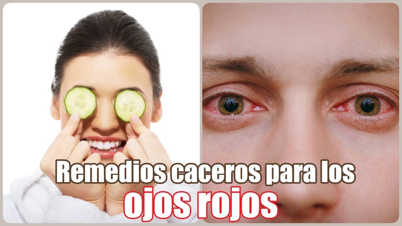 Remedios caseros para los ojos rojos - YouTube