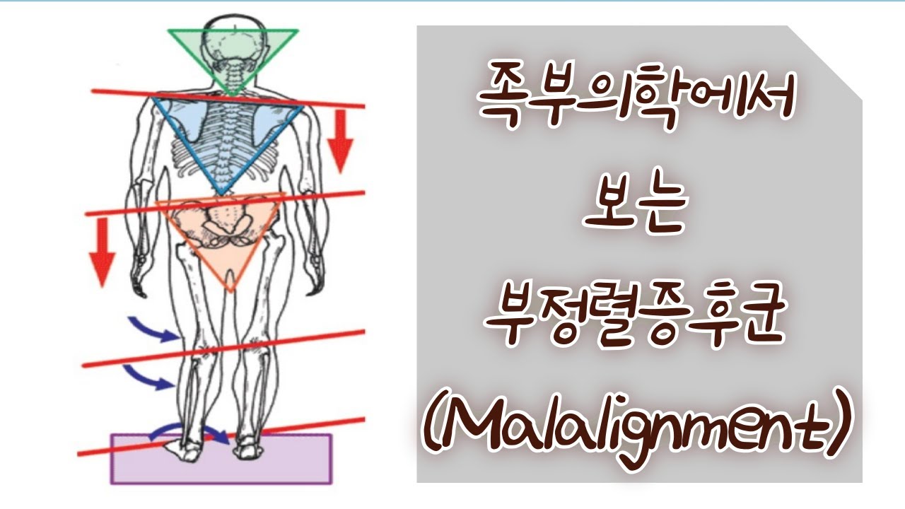 족부의학에서 보는 부정렬증후군(Malalignment) - YouTube