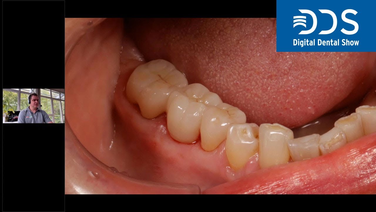 The full spectrum of the Zolid DNA Generation | #DigitalDentalShow ...