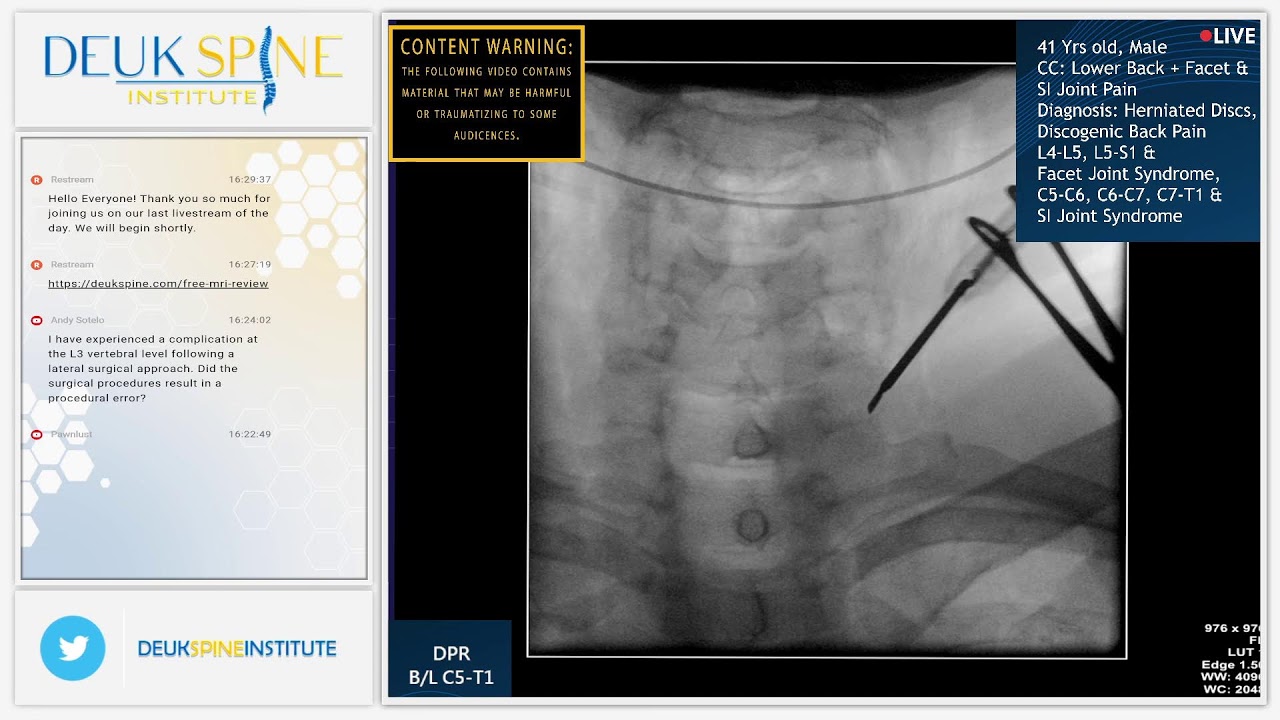 Cervical Deuk Plasma Rhizotomy C5-T1 for Neck Pain from Facet Joint ...