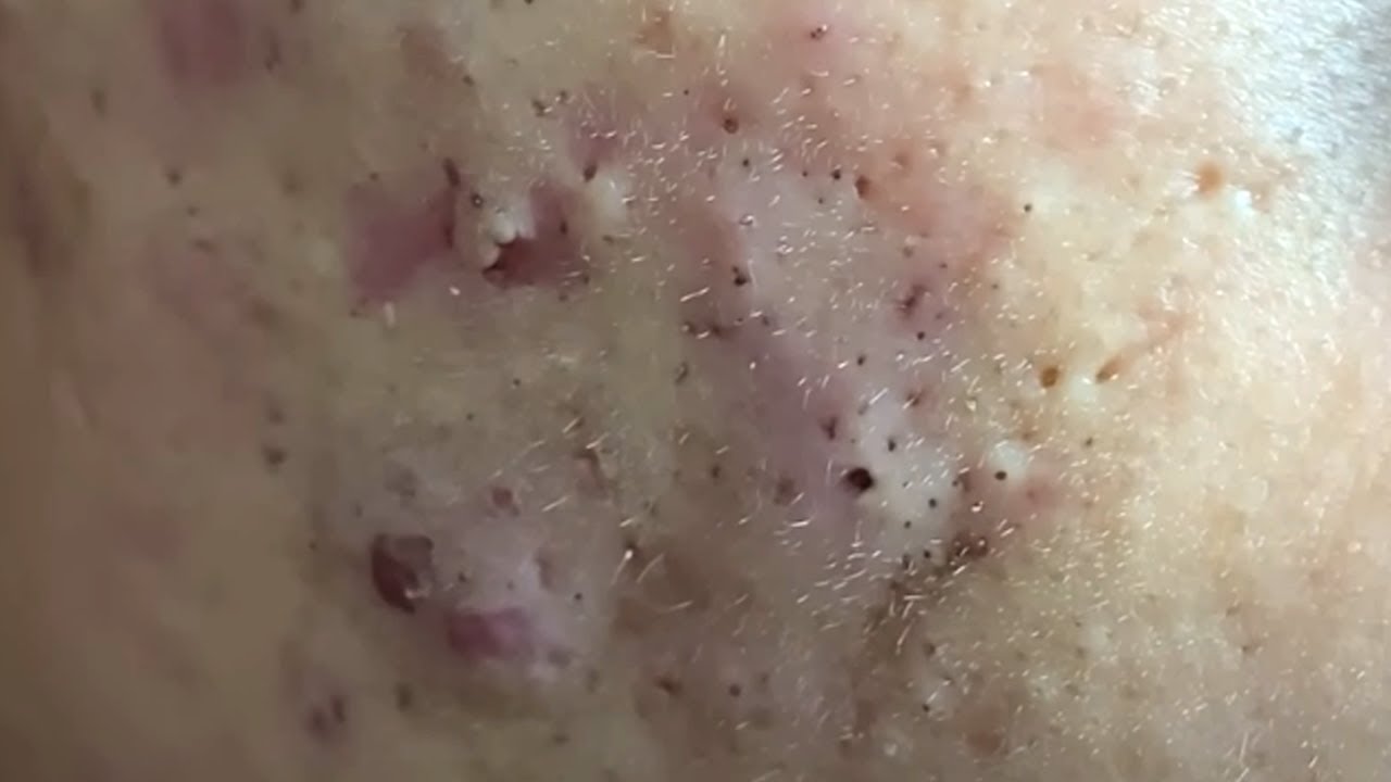 "Satisfying Blackhead & Whitehead Removal! 😲 Pimple Popping | Acne ...