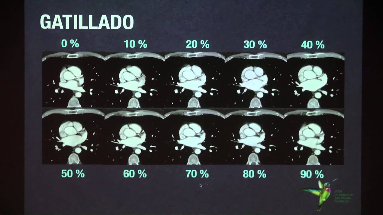 Angiotac de tórax - YouTube