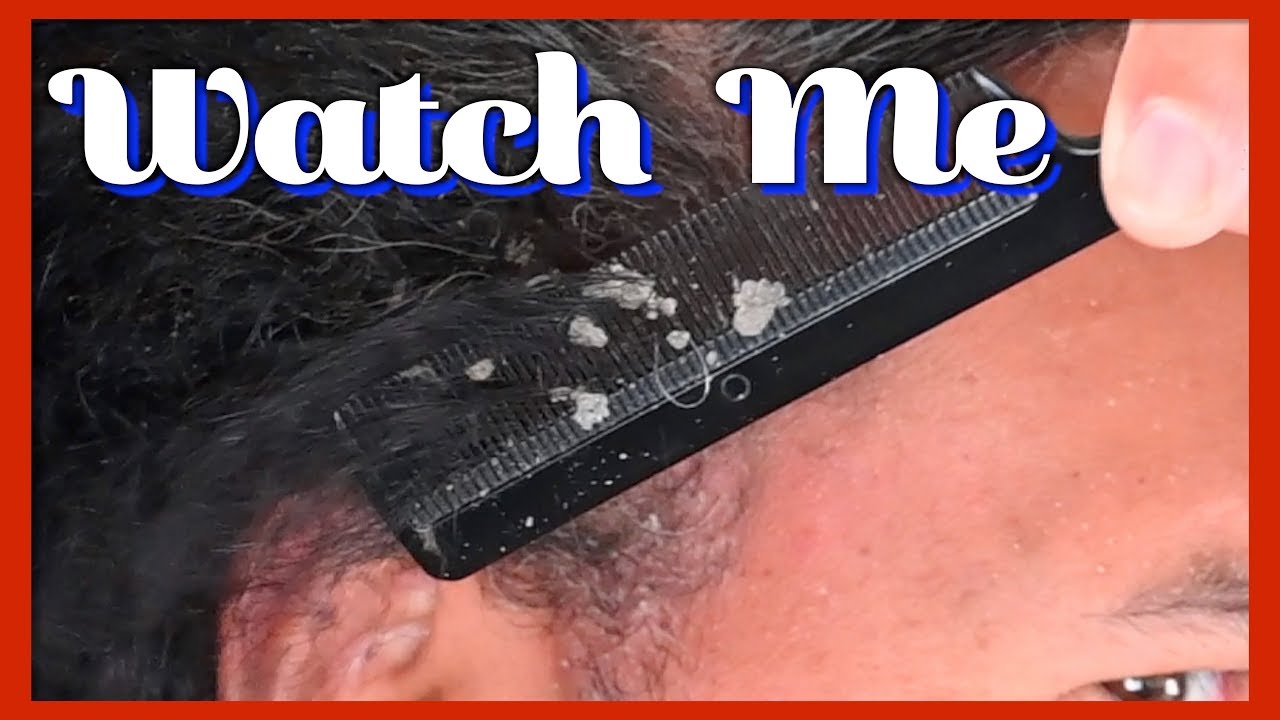 Dandruff Scratching Asmr Relaxation Sounds Scratch Part Lift