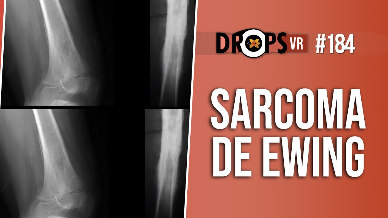 SARCOMA DE EWING - RECONHECENDO NO RX - YouTube