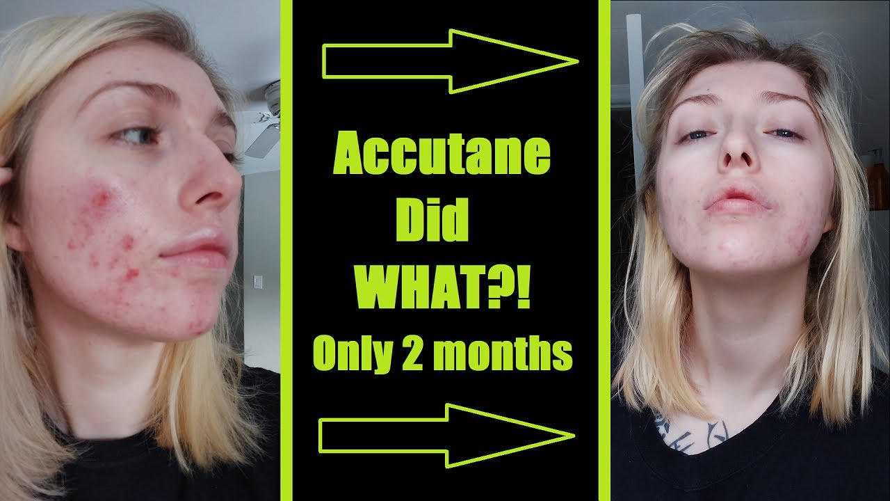 WTF Side Effects Of Accutane After 2 Months - YouTube