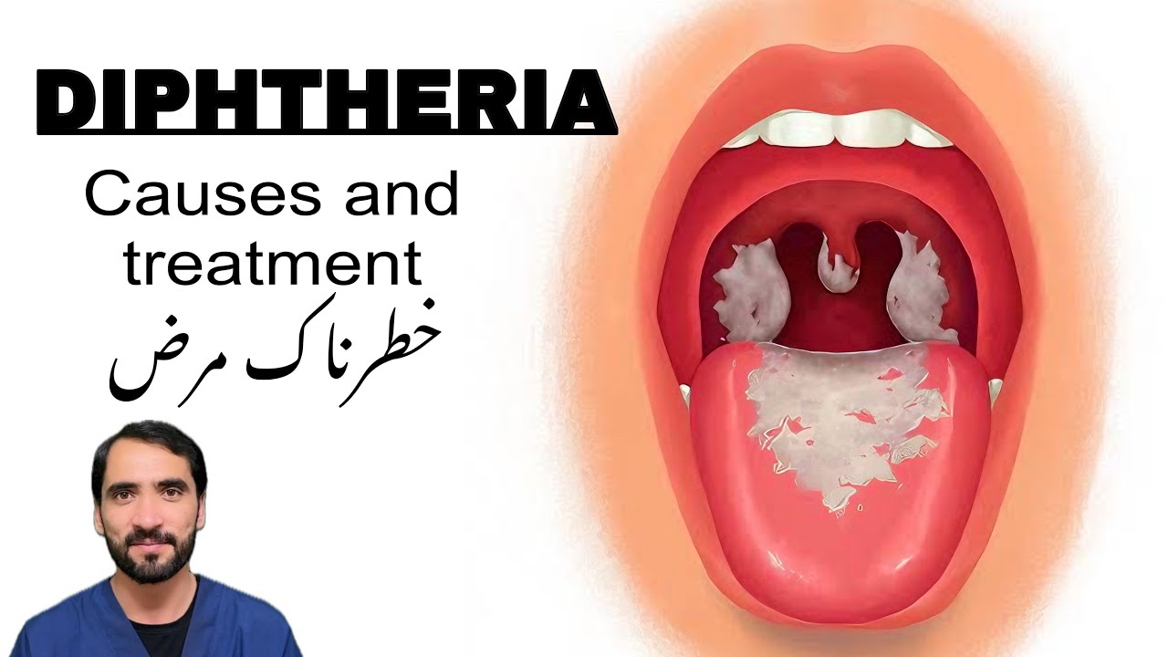 Diphtheria - Symptoms, Causes and treatment - YouTube
