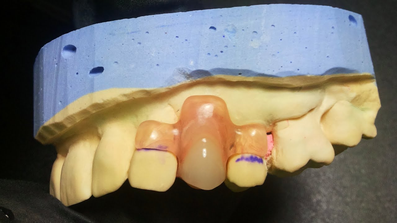 Δοντι με πλαστικα αγκιστρα _ οδοντοτεχνικο εργαστηριο κυπρος / Tooth ...