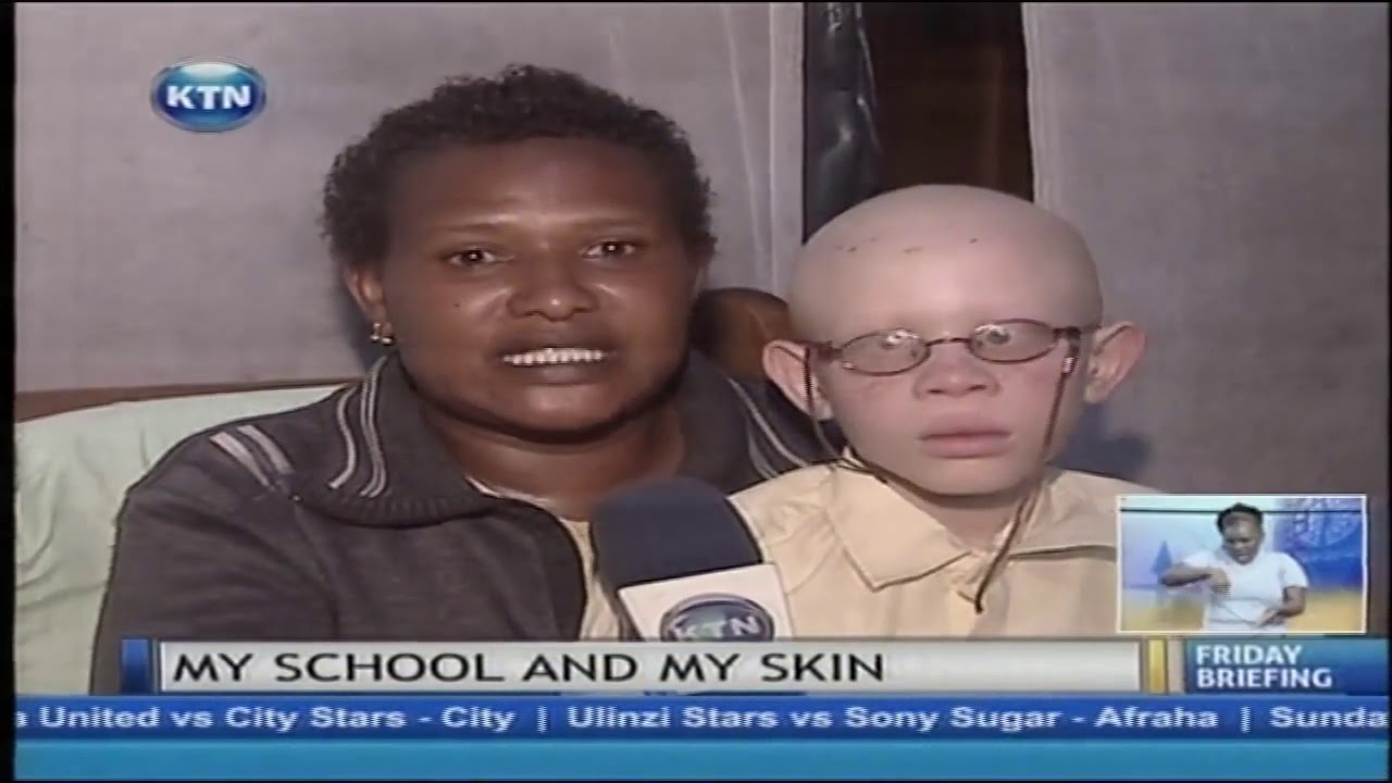 Children With Albinism have all it takes go to Normal Schools - YouTube