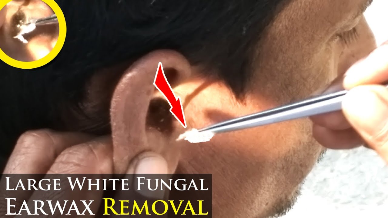Extra Large Plugs Earwax Removal in Anxious Client / Pulled Out Lots of ...