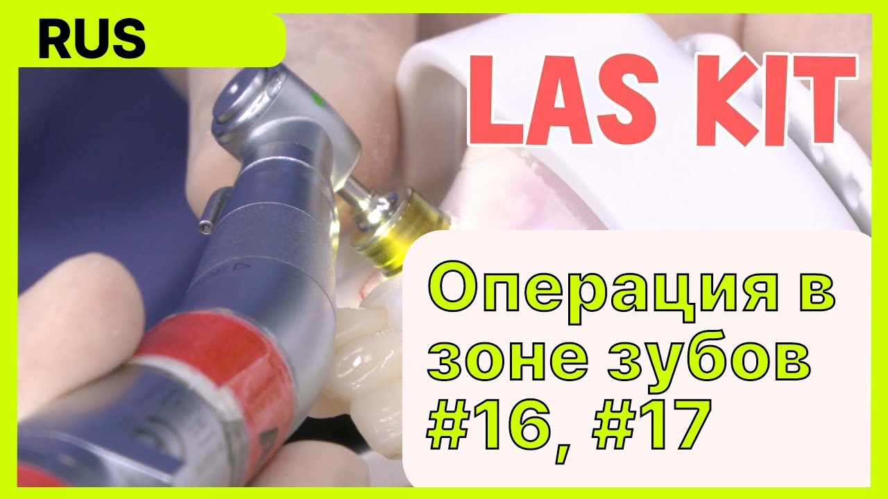 [Практические советы] LAS KIT - Операция в зоне зубов #16, #17 - YouTube
