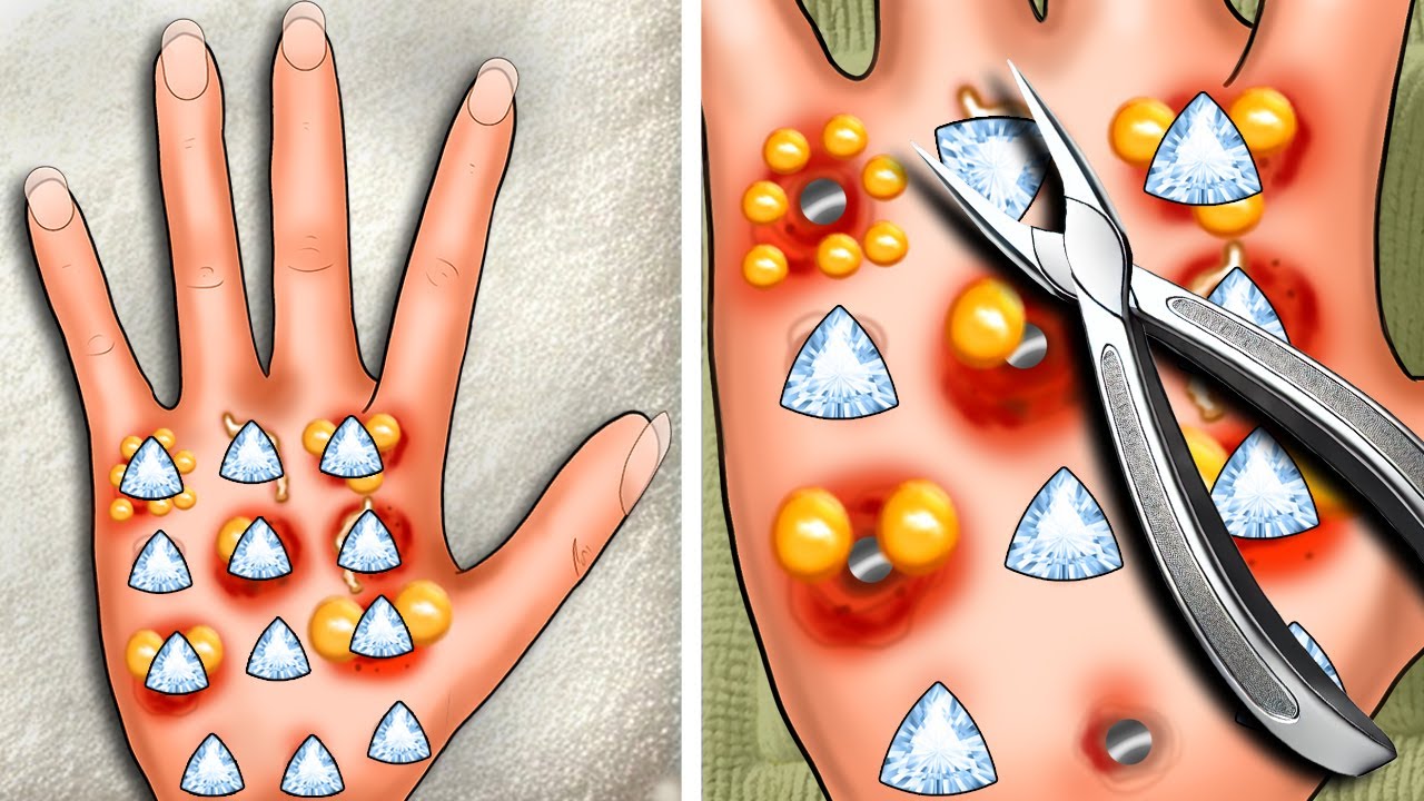 ASMR Unmanaged Hand Piercing Goes Wrong Pus animation| Body ...