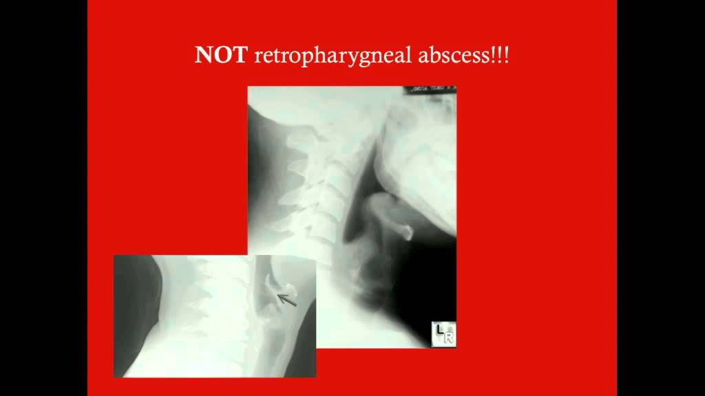 ENT Abscesses - CRASH! Medical Review Series - YouTube