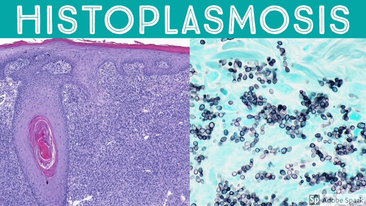 Histoplasmosis: Two Extreme Examples (Pseudotumor & Zero Inflammation ...