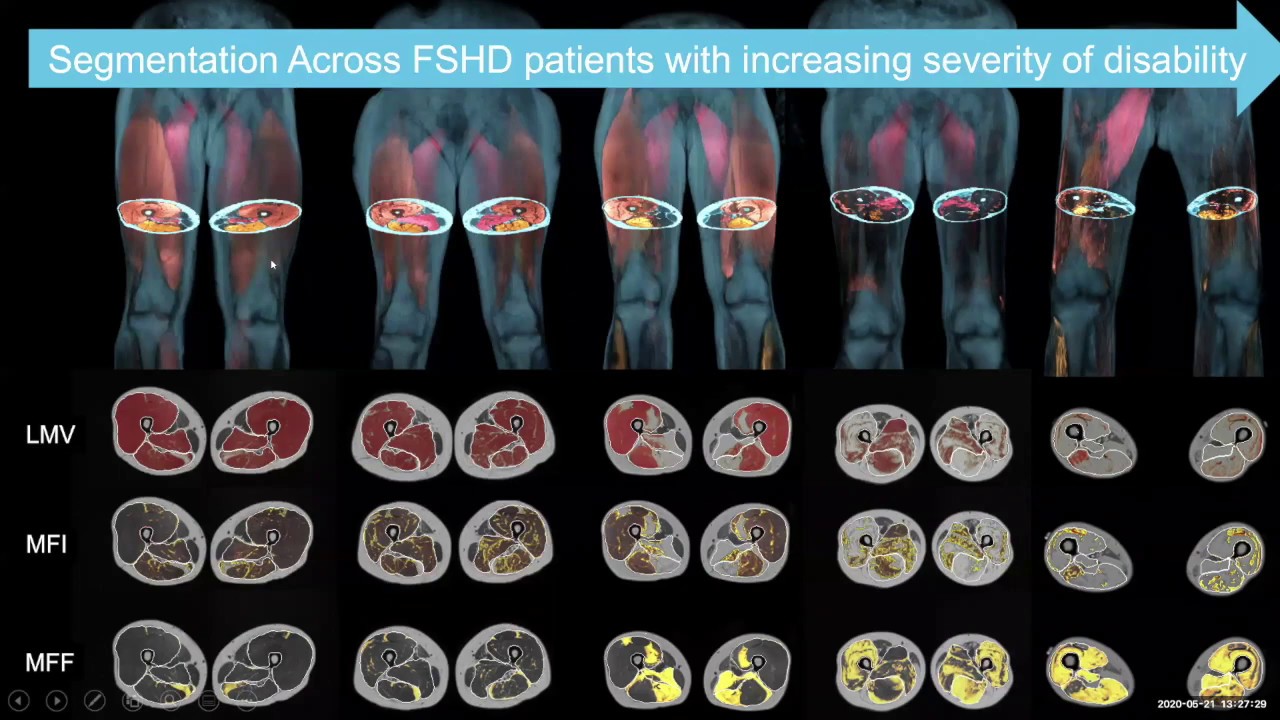 Fulcrum Therapeutics' preparatory studies for clinical trials in FSH ...