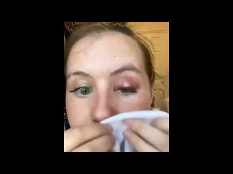 Best pimple explosions of all times - YouTube