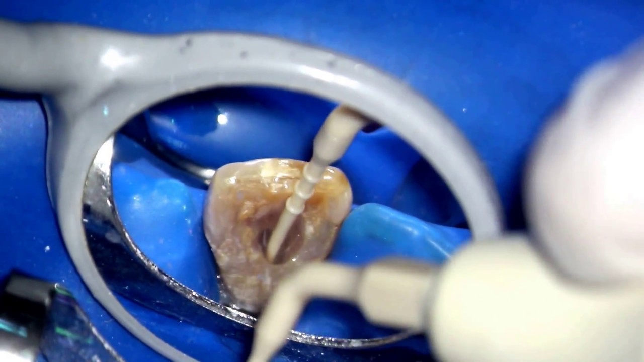 ultrasonic activation of irrigant. - YouTube