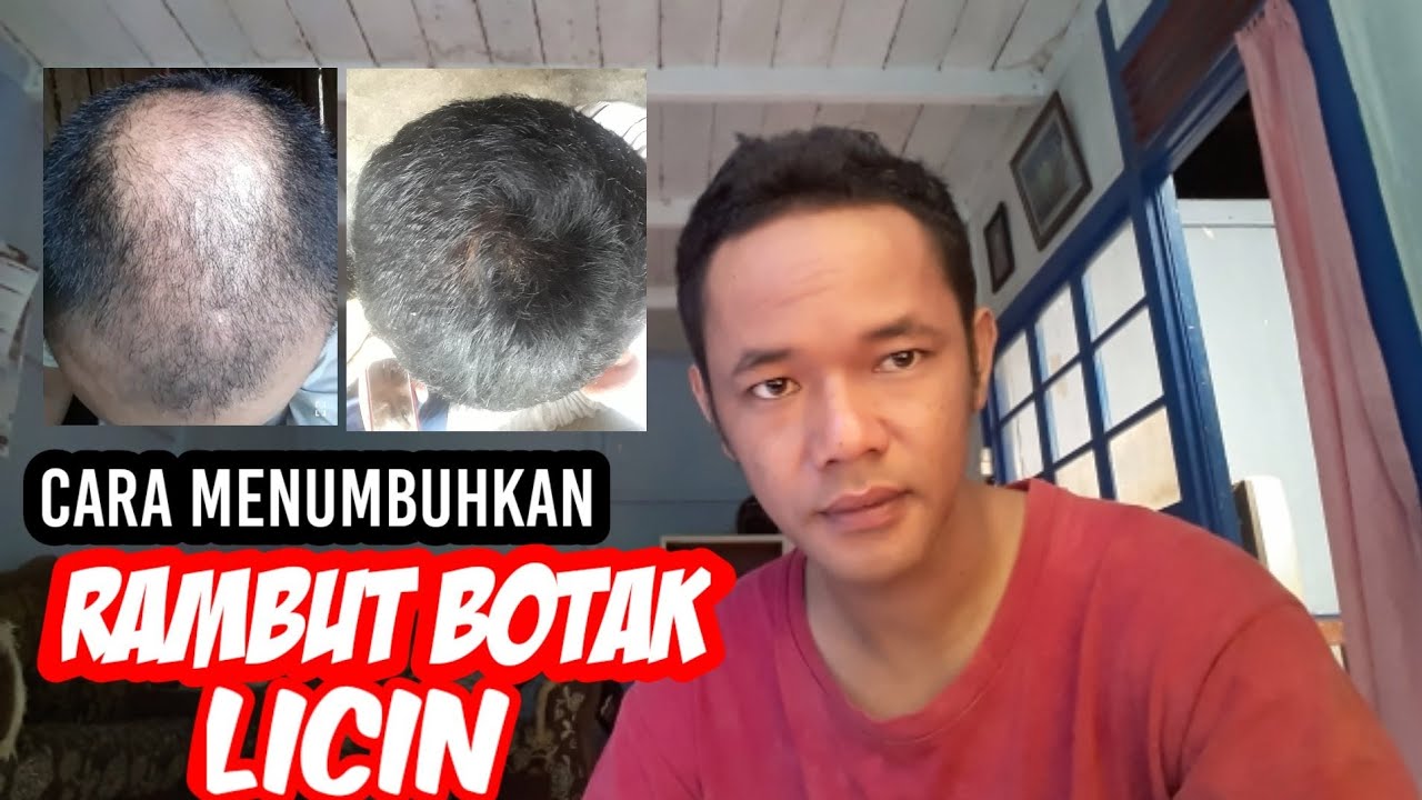 Cara menumbuhkan rambut botak licin - YouTube