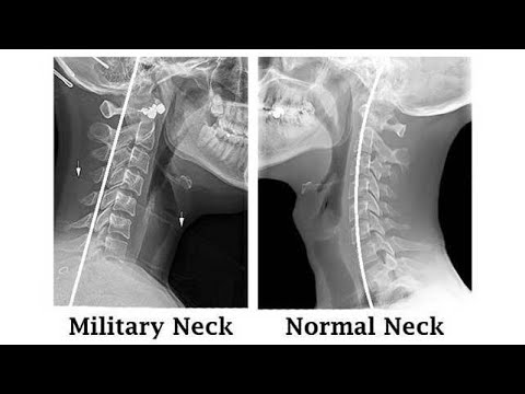 How Neck Posture Affects Your Brain & Concussion Recovery - YouTube