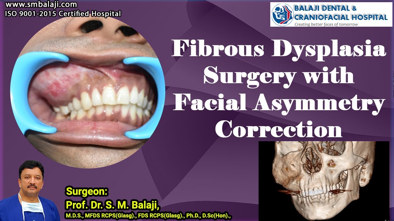 Fibrous Dysplasia Surgery with Facial Asymmetry Correction - YouTube