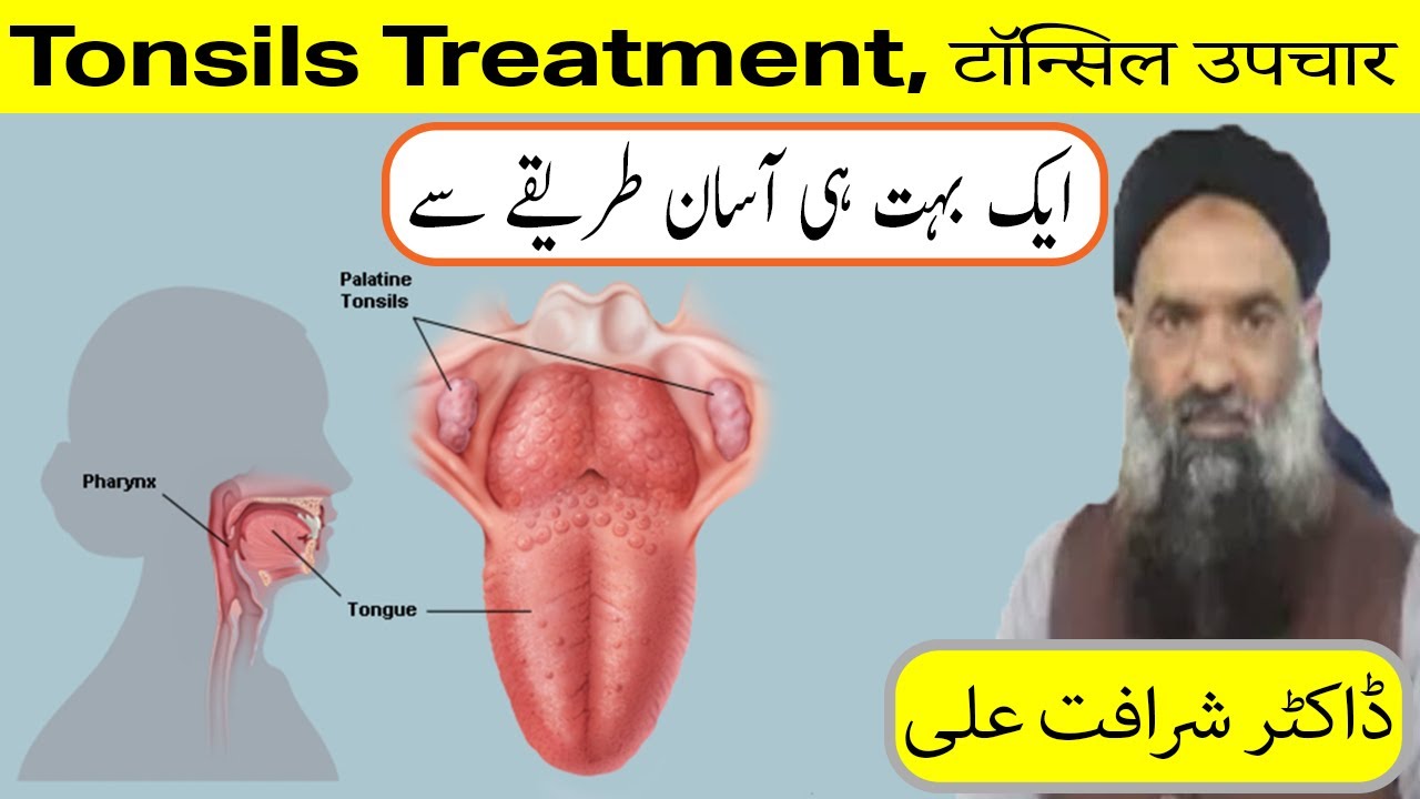 Tonsils of Treatment in urdu & hindi || Tonsils ka ilaj || टॉन्सिल ...