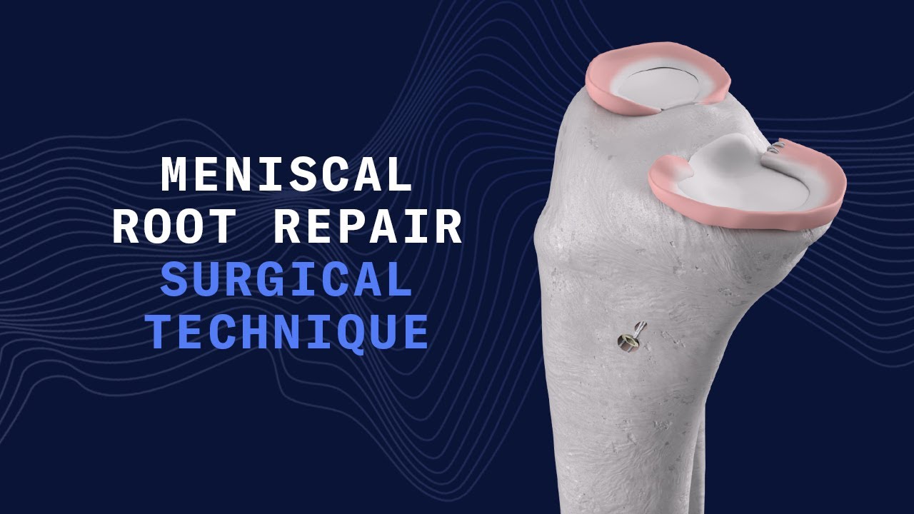 Presenting Auxein’s Meniscal Root Repair System - YouTube