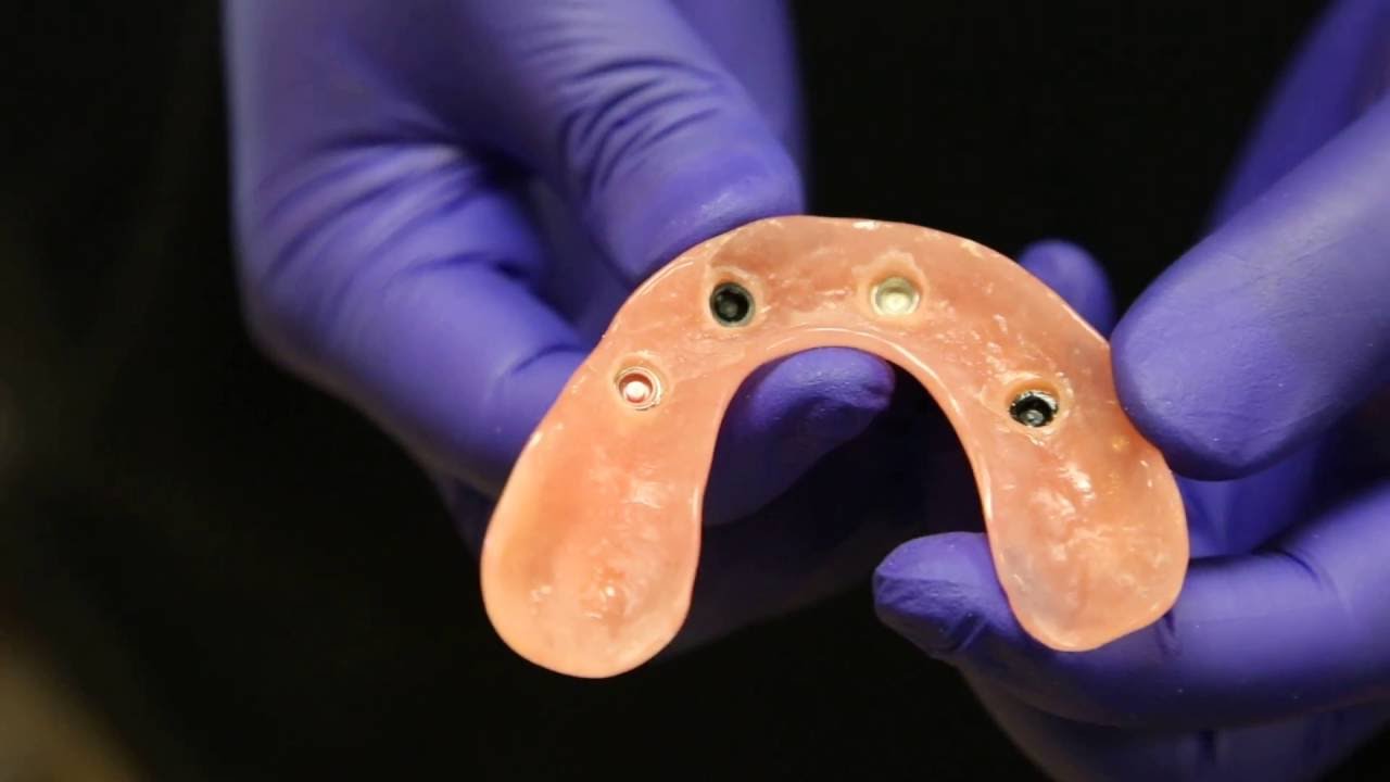 4 implant-retained Full Upper Denture, Dentistry at Greenway - YouTube