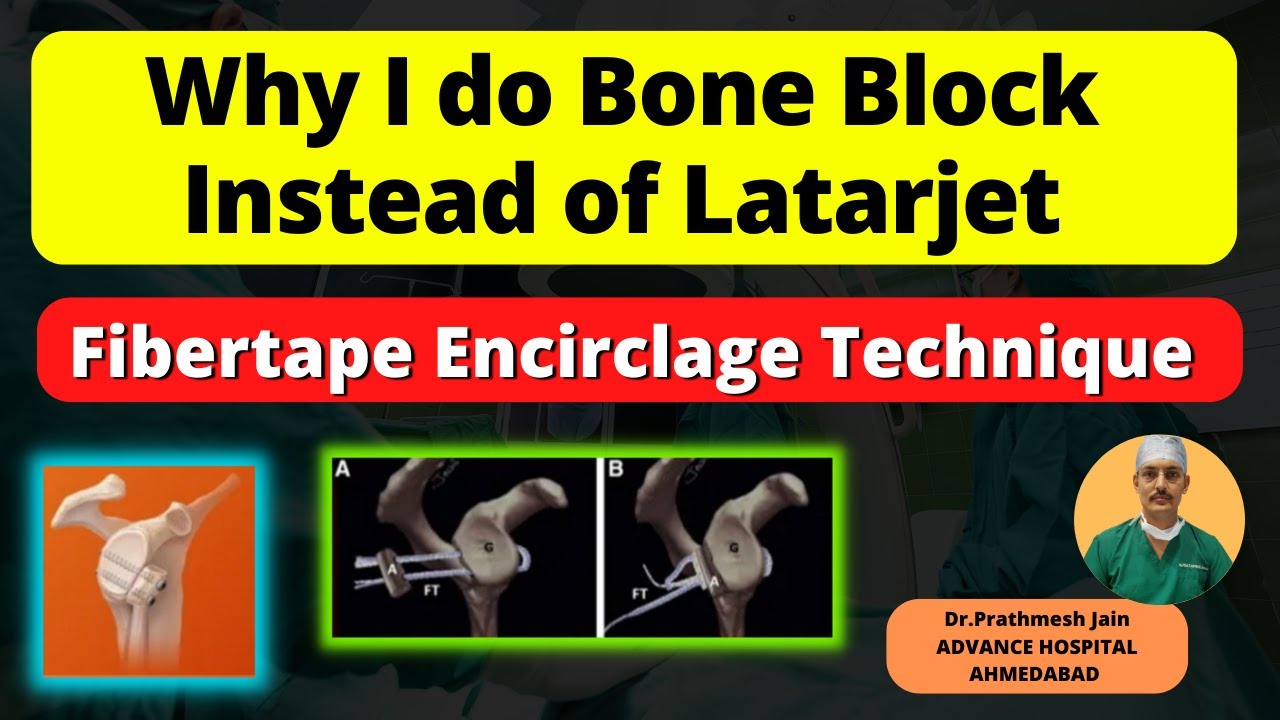Why I do Bone Block Instead Of Latarjet for Bone loss in Shoulder ...