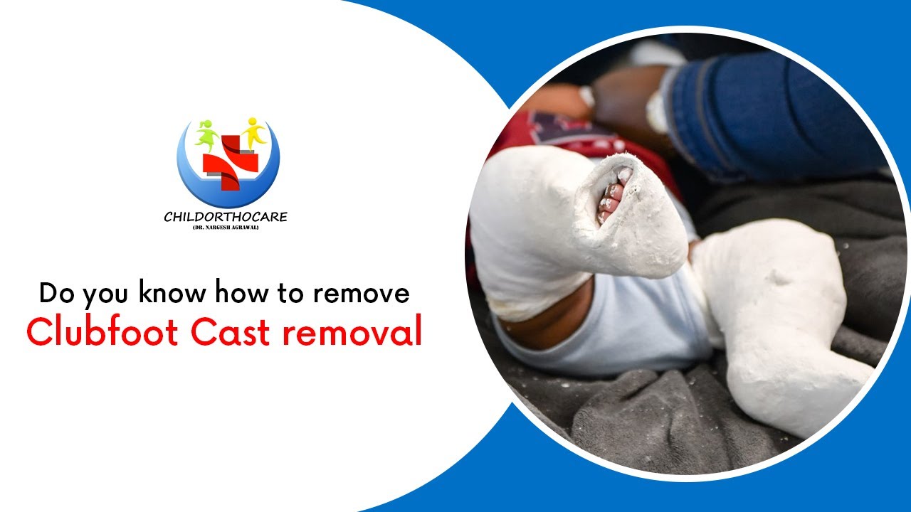 Clubfoot Cast removal - YouTube