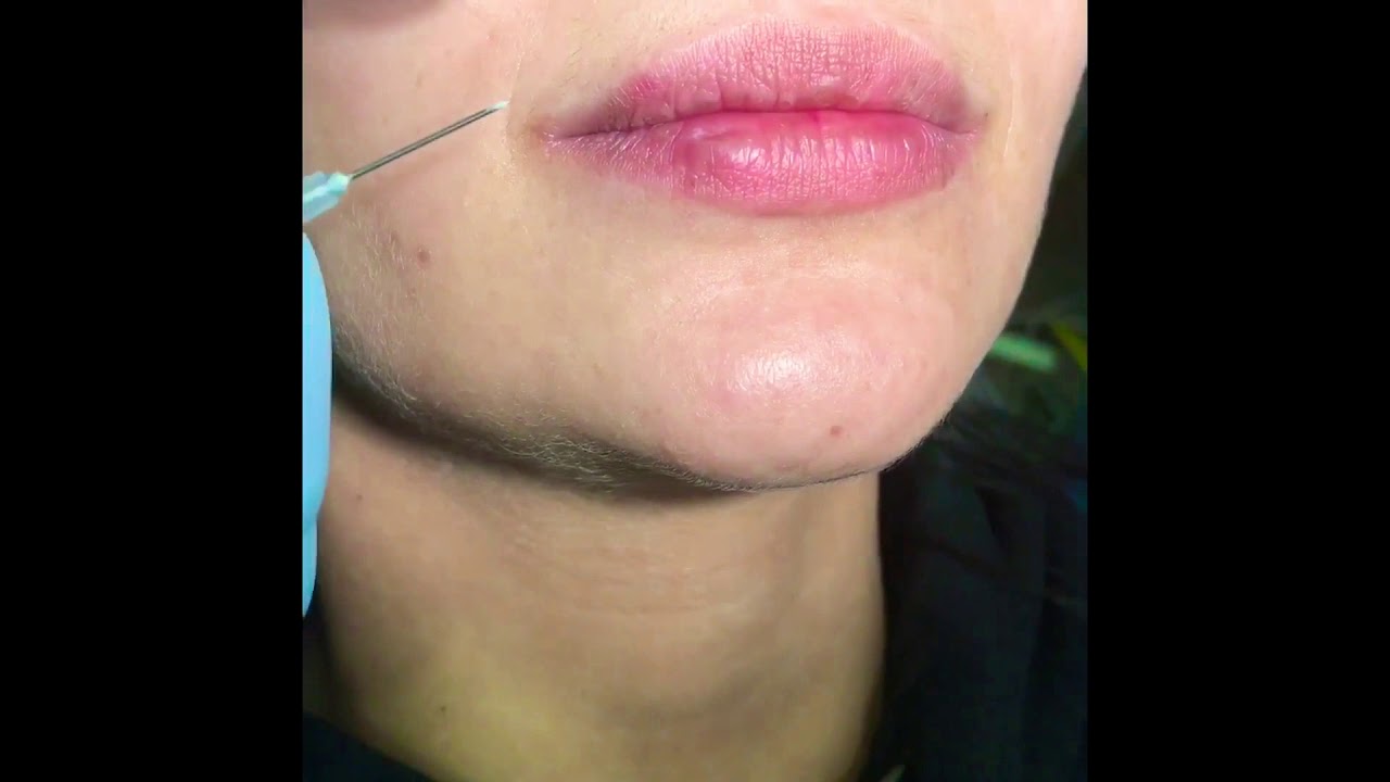 Augmentation des lèvres par Acide Hyaluronique - Technique d’injection ...
