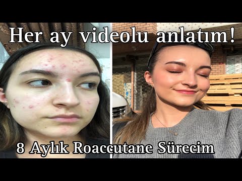 SİVİLCE TEDAVİM | Her Ay Videosunu Çektiğim 8 Aylık Roaccutane Sürecim