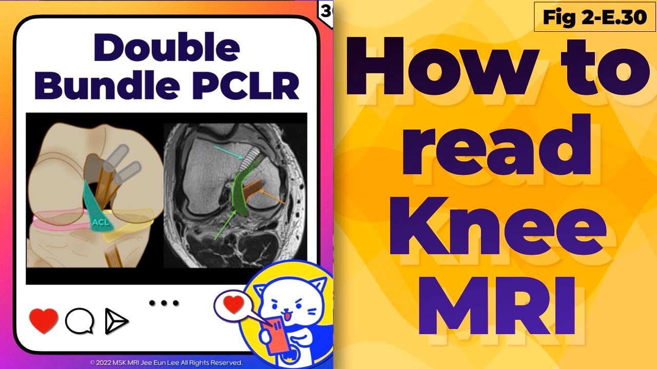 (Fig 2-E.30) Double-bundle PCL reconstruction, Femoral Tunnel Placement ...